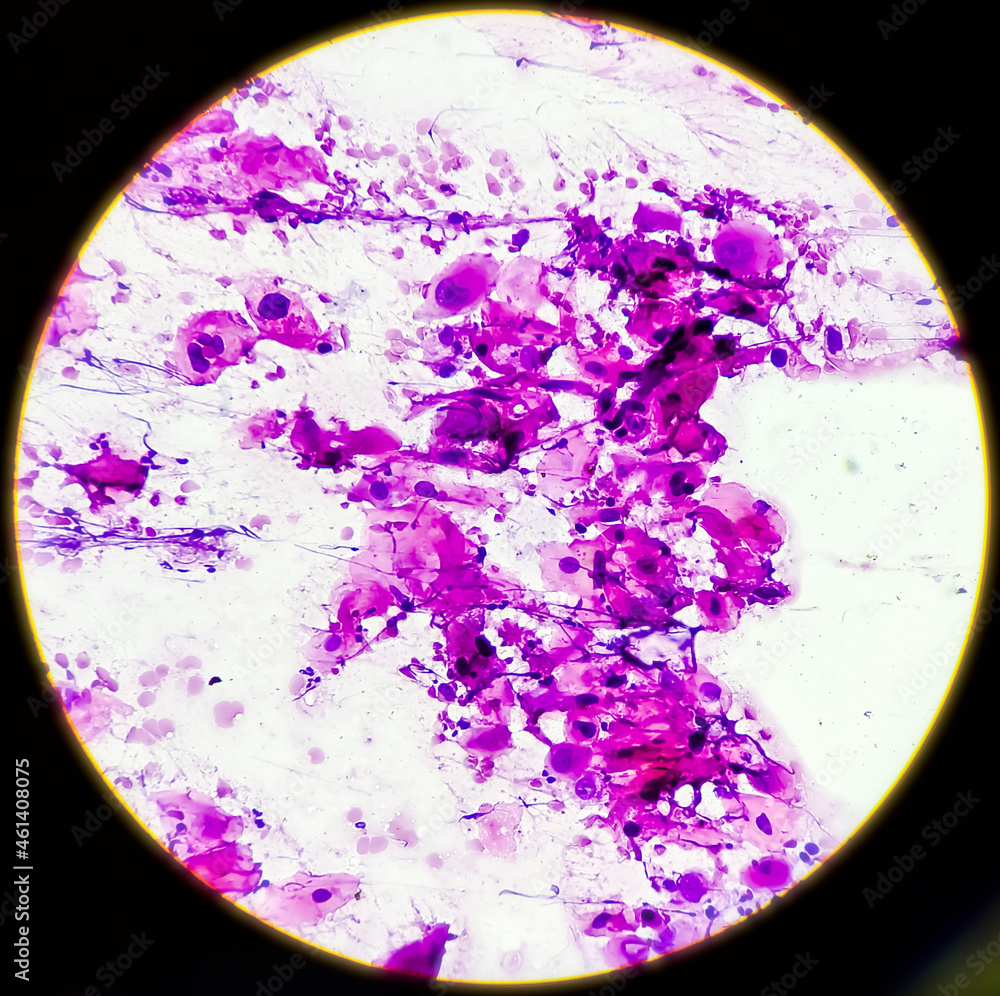Microscopic view of Metastatic squamous cell carcinoma, atypical ...