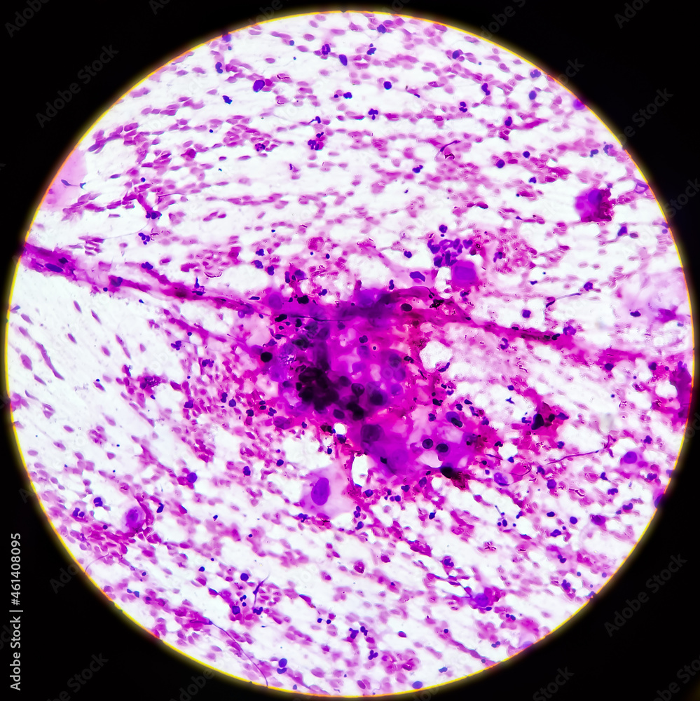 Microscopic view of Metastatic squamous cell carcinoma, atypical ...