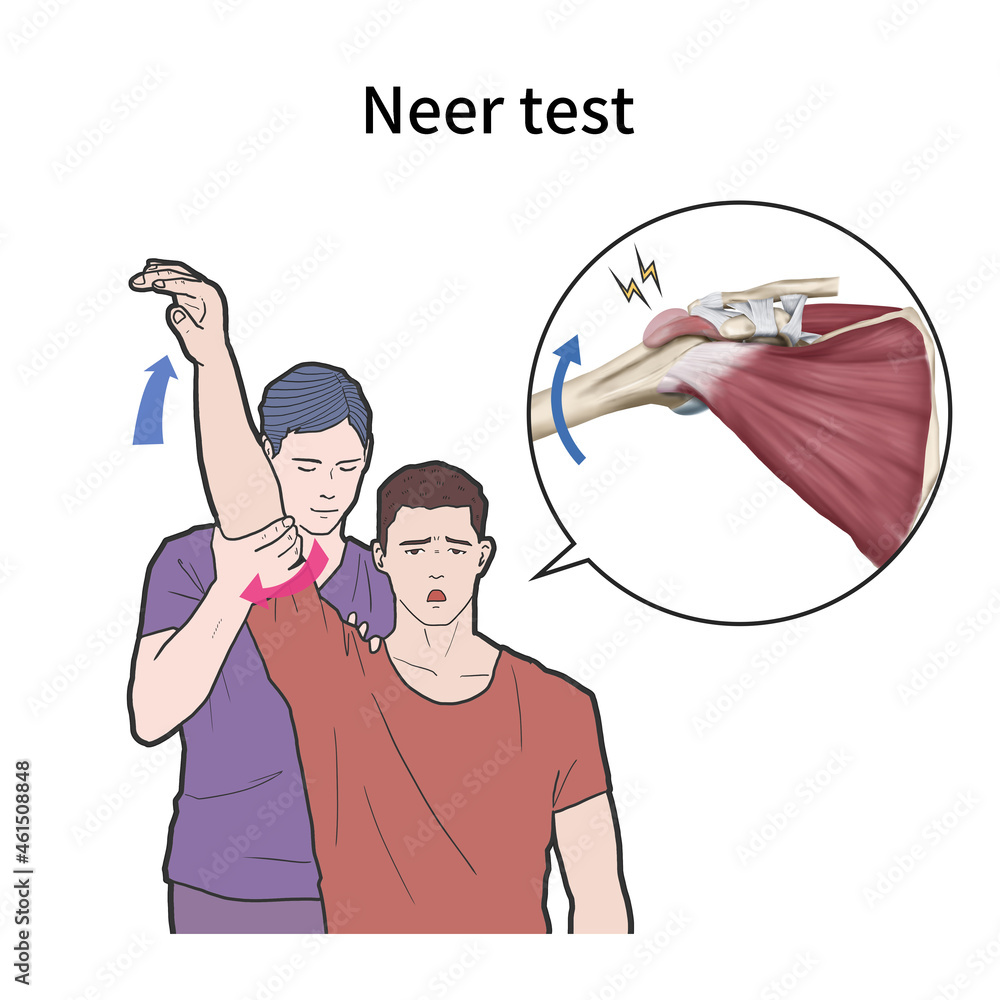 neer test 어깨충돌증후군 Иллюстрация Stock | Adobe Stock