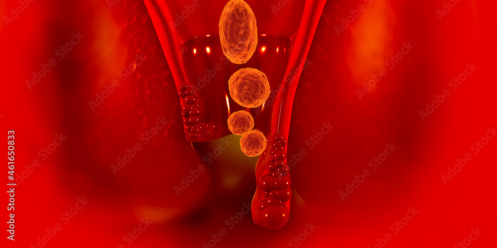 Human hemorrhoids , piles, fistula, fissure. 3d illustration Stock ...