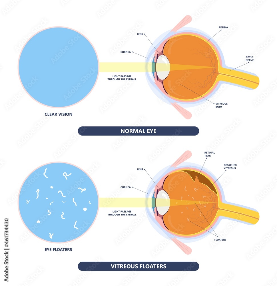 Eye floaters fluid vision retina myopia trauma surgery loss of light ...