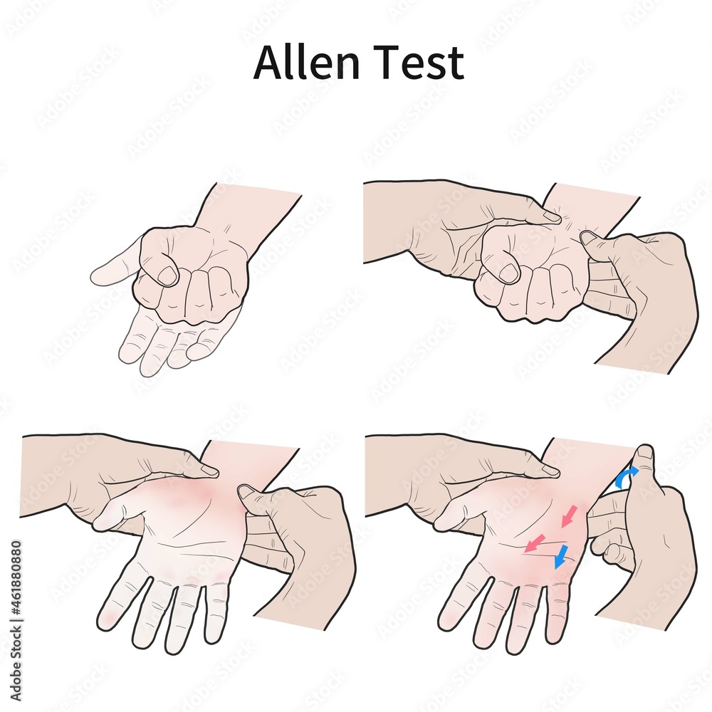 알렌테스트 수족냉증 검사 ilustración de Stock | Adobe Stock