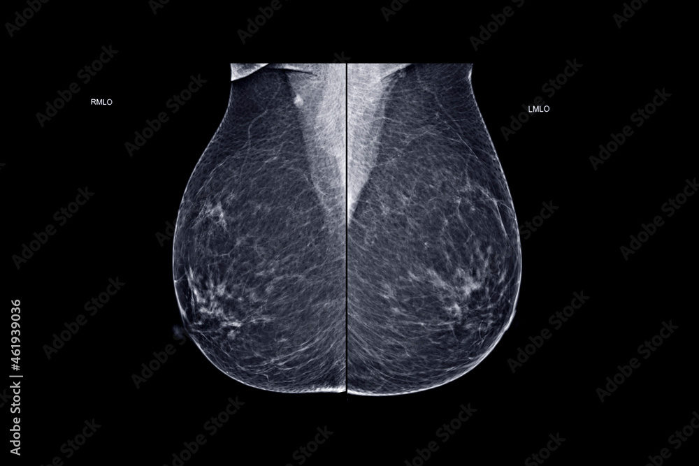 X-ray Digital Mammogram or mammography both side of the breast MLO view ...