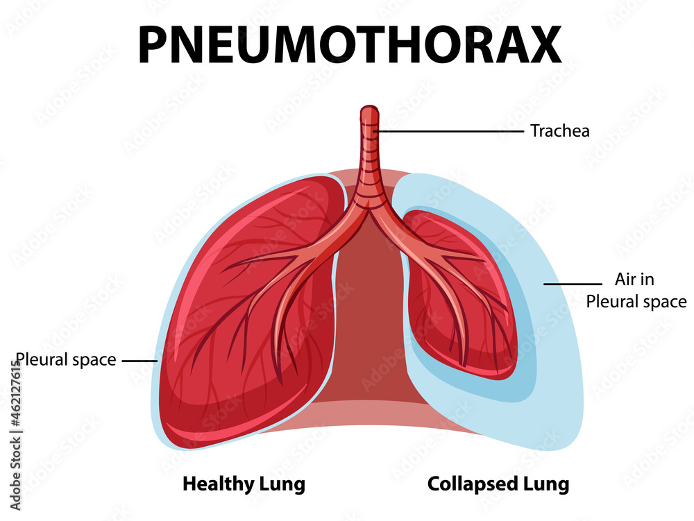 Pneumothorax diagram with collapsed lung and healthy lung Stock Vector ...
