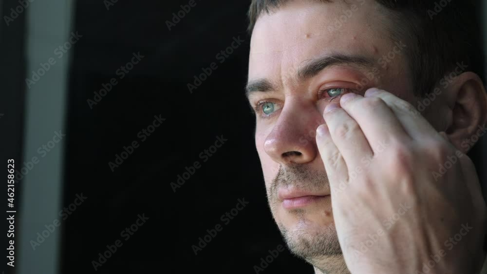 Close Up of Sad Man Touch His Severe Bloodshot Red Blood Eye Affected ...