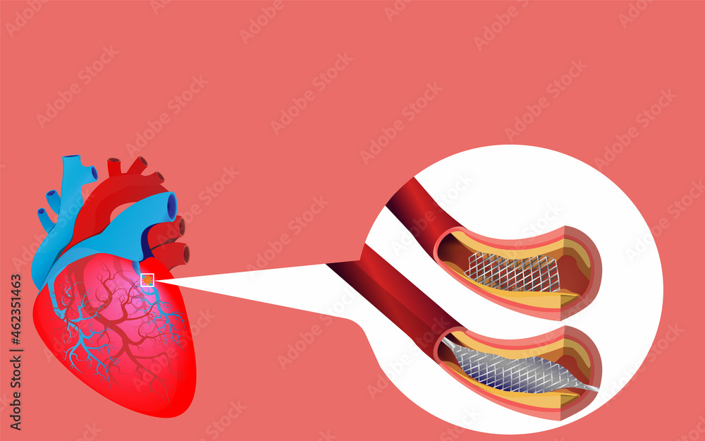 Stent implantation for heart coronary. Coronary artery bypass surgery ...