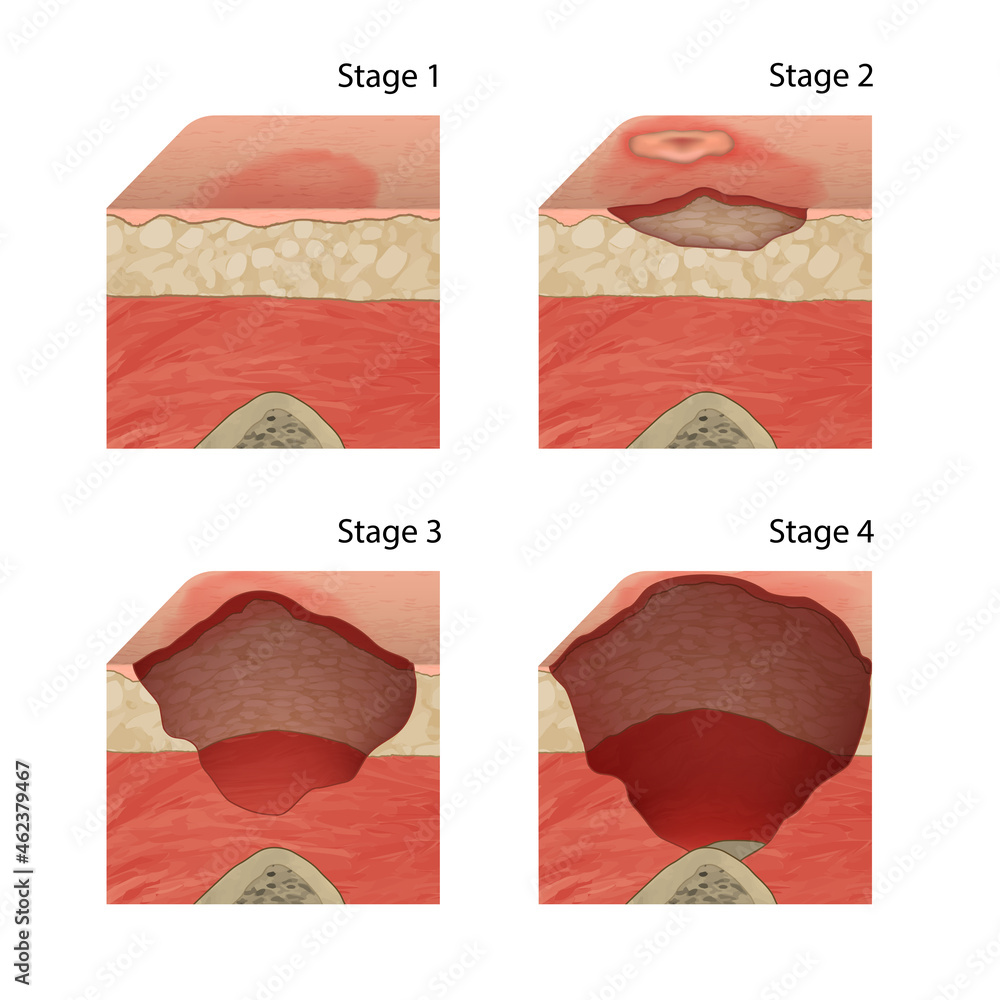 Pressure ulcers. Injuries to the skin and underlying tissue caused by ...