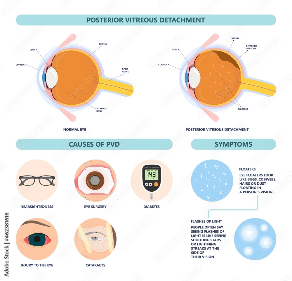 Eye floaters fluid vision retina myopia trauma surgery loss of light ...