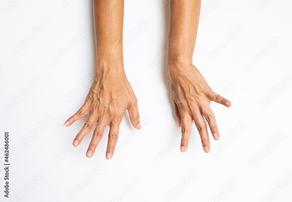 Finger and hand of people with abnormal muscle symptom and problem ...