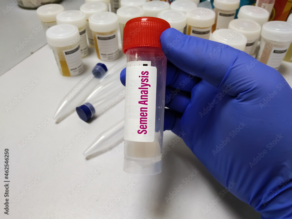 Semen analysis, sperm analysis doctor hold a container with semen ...