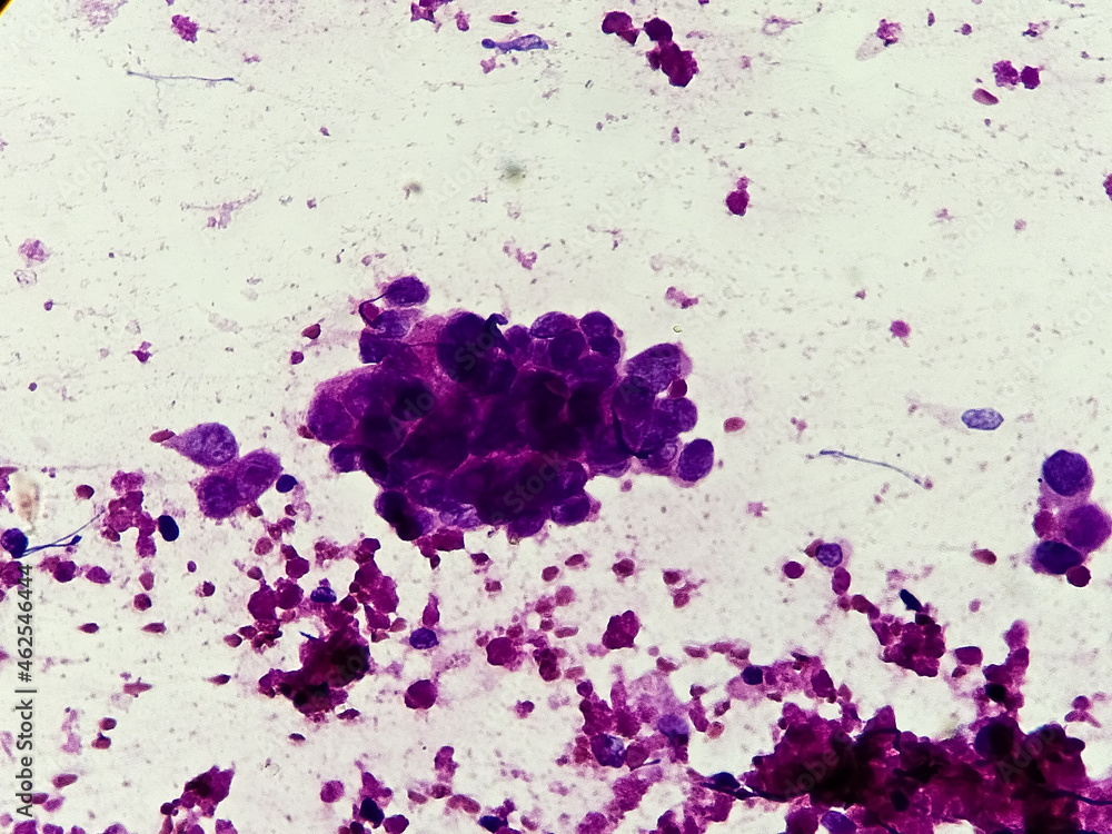 Left breast lump (FNA) microscopic 100x show positive for malignant ...