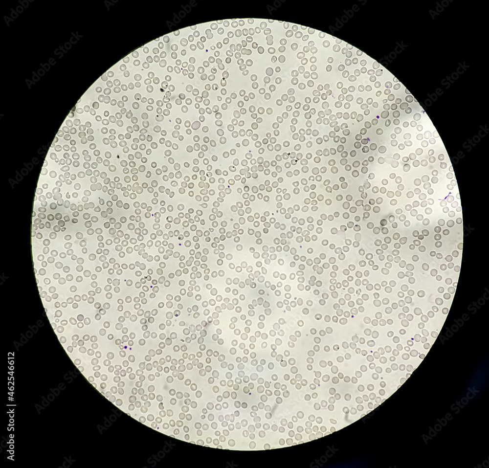 Blood smear leishman stained Microscopic 100x show leucocytopenia and ...