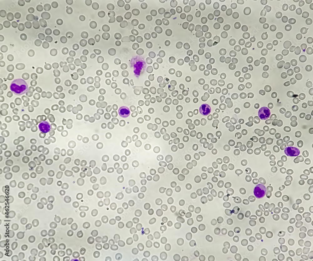 Blood film or smear leishman stained Microscopic show Leuco ...