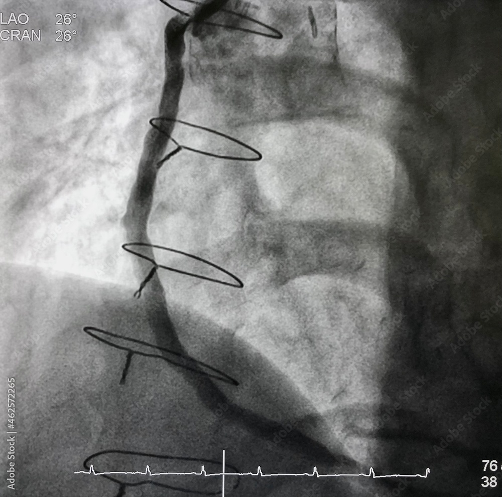 coronary angiogram showed saphenous vein graft (SVG) after Drug Eluting ...