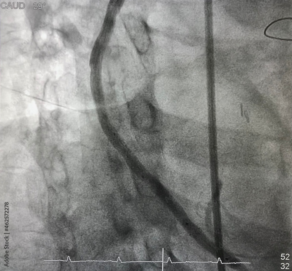 coronary angiogram showed saphenous vein graft (SVG) after Drug Eluting ...