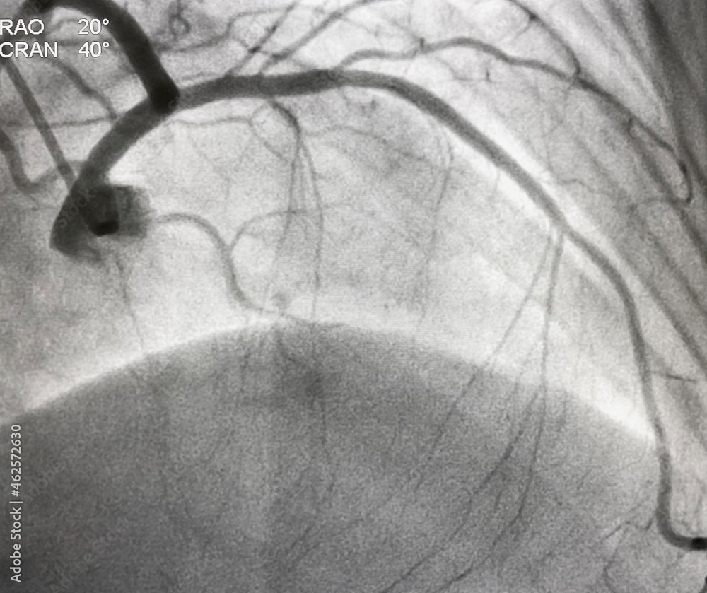 Normal left coronary artery (LCA) angiography. Stock Photo | Adobe Stock