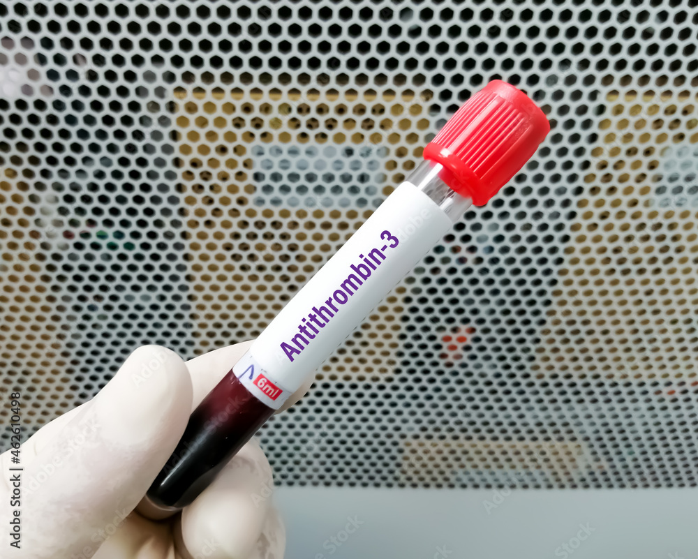 Blood sample tube for Antithrombin III test. diagnosis for clotting ...