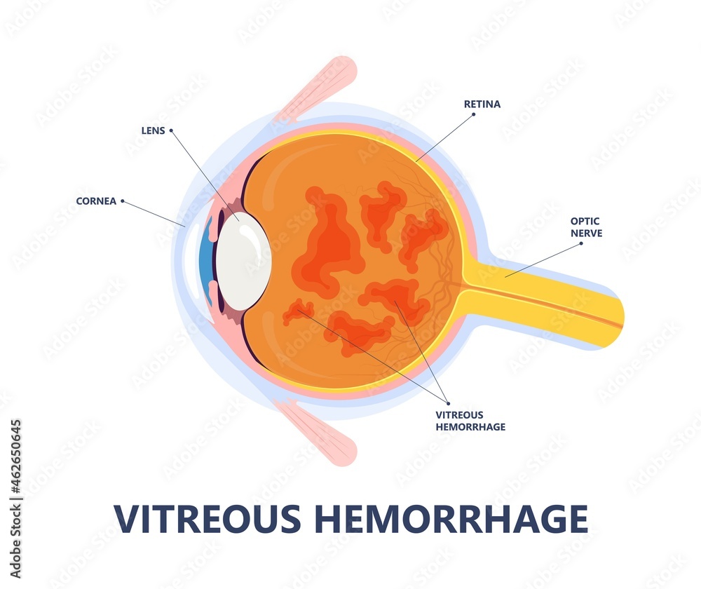 Eye floaters fluid vision retina myopia trauma surgery loss of light ...