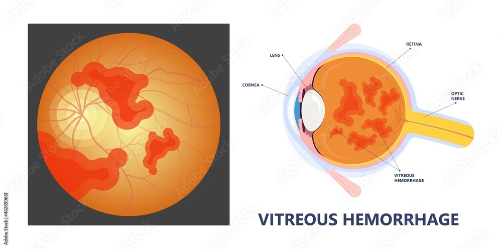 Eye floaters fluid vision retina myopia trauma surgery loss of light ...