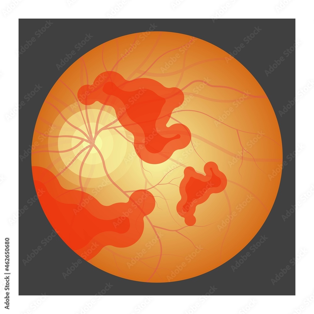 Eye floaters fluid vision retina myopia trauma surgery loss of light ...