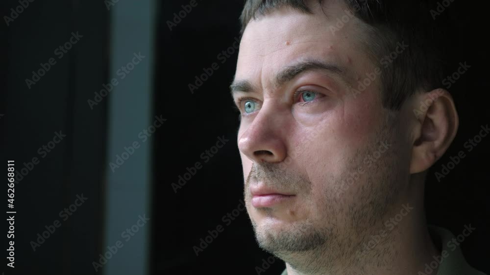 Sick Man with One Annoyed Red Blood Eye with Symptom of Conjunctivitis ...