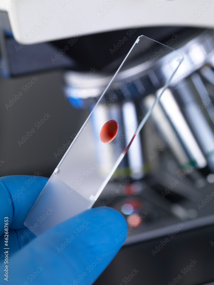 Scientist examining a glass slide containing a human sample under a ...