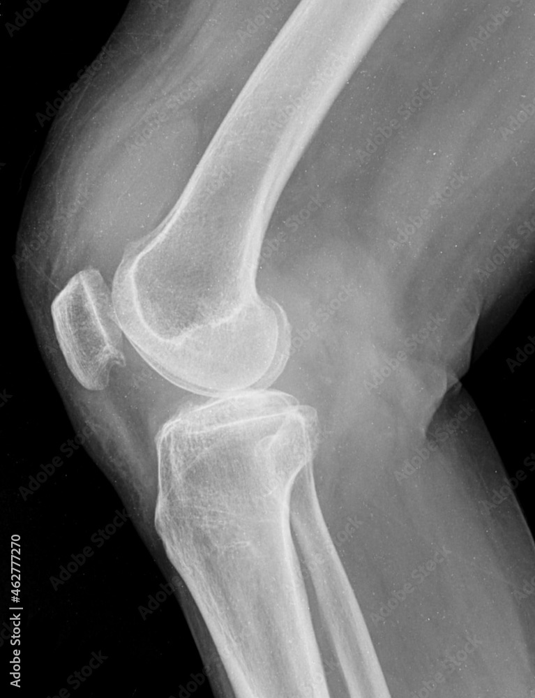 Poster x ray of a supra patella joint effusion knee – Wall Art | UkPosters