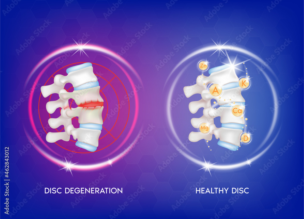 Spine disease, normal backbone, degenerative disc and herniated disc ...