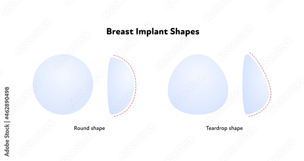 Female breast surgery infographic chart. Vector flat medical ...