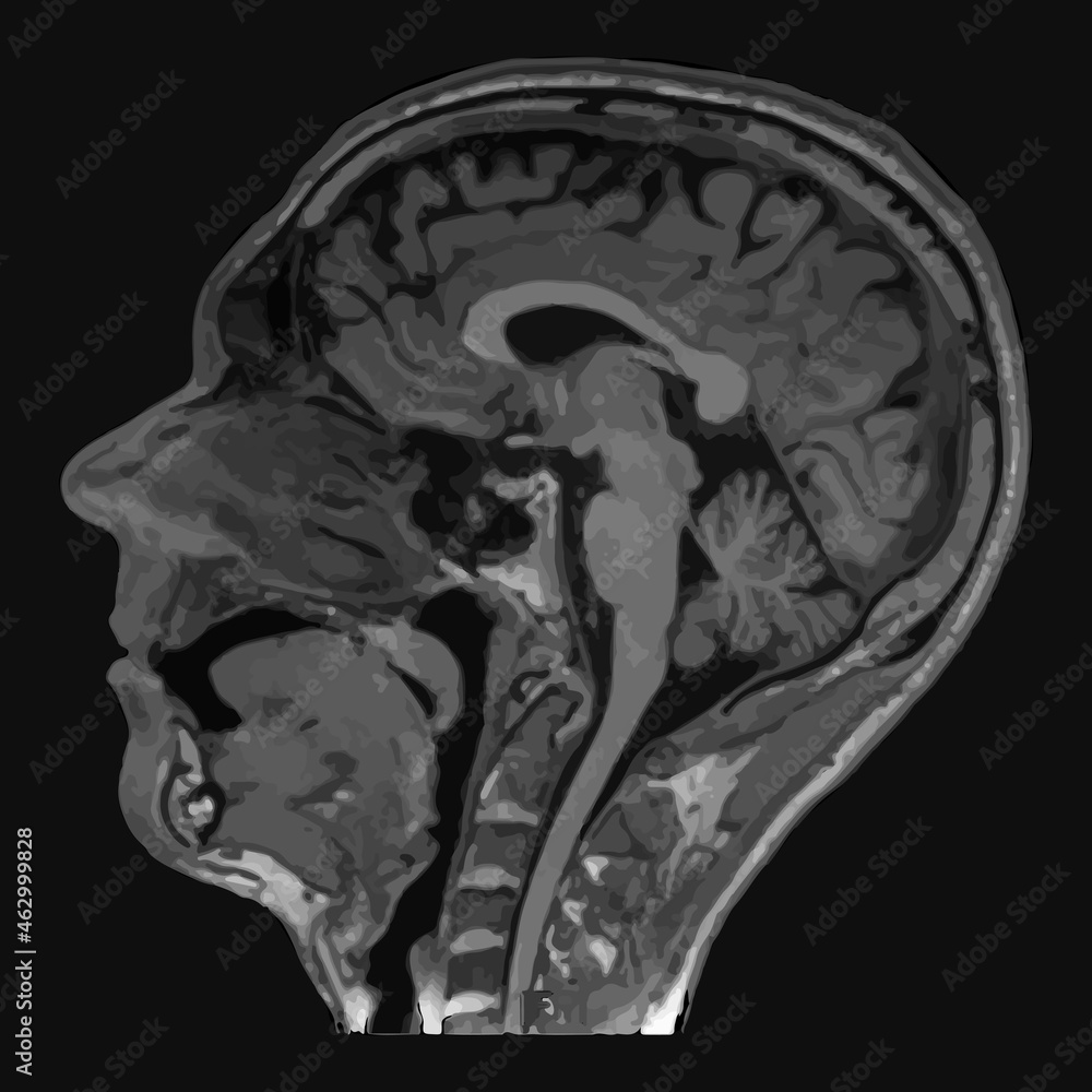 Realistic image sagittal of male head with CT scan, MRI Magnetic ...