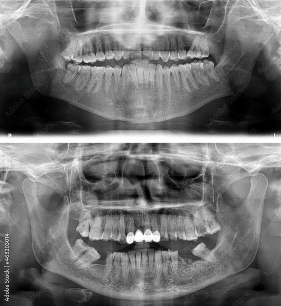 Comparison between a panoramic x-ray image of teeth of an healthy teeth ...