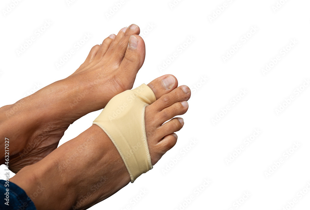A middle age woman feet have bunion bent toe problem wearing foot ...