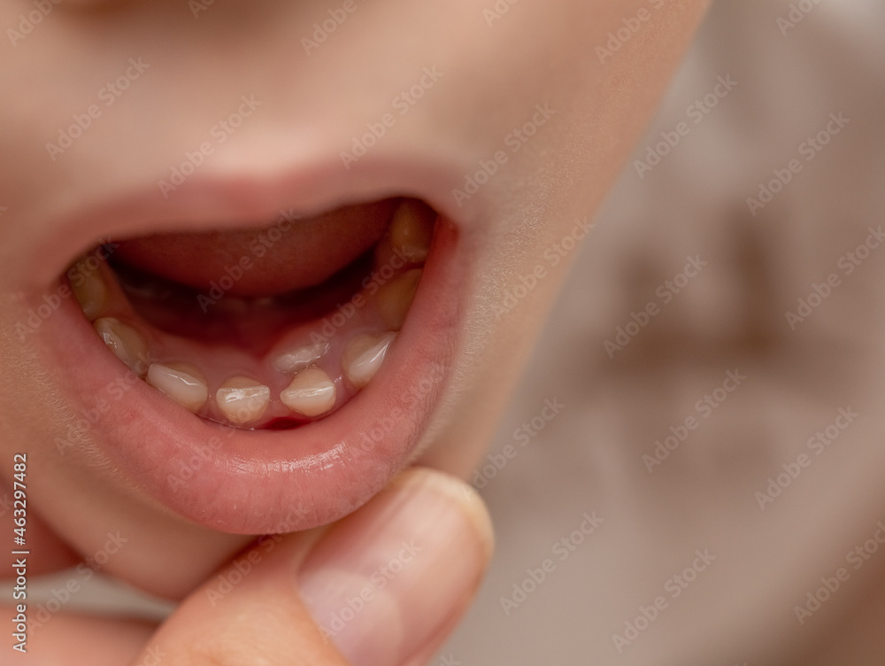 The eruption of the main tooth in a child next to the milk tooth ...