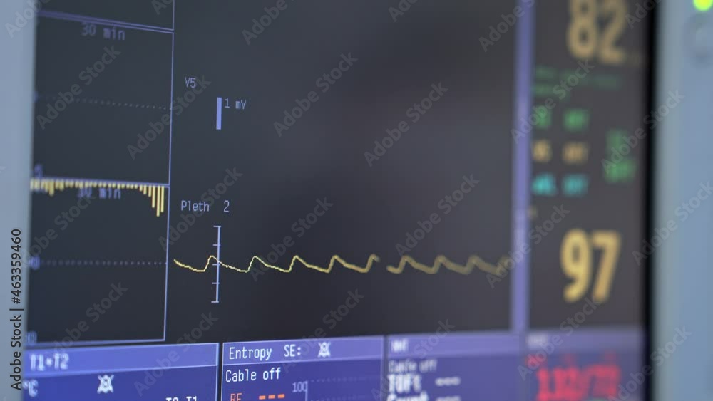 Screen of anesthesia surgery monitor. Vital signs of a patient showing ...