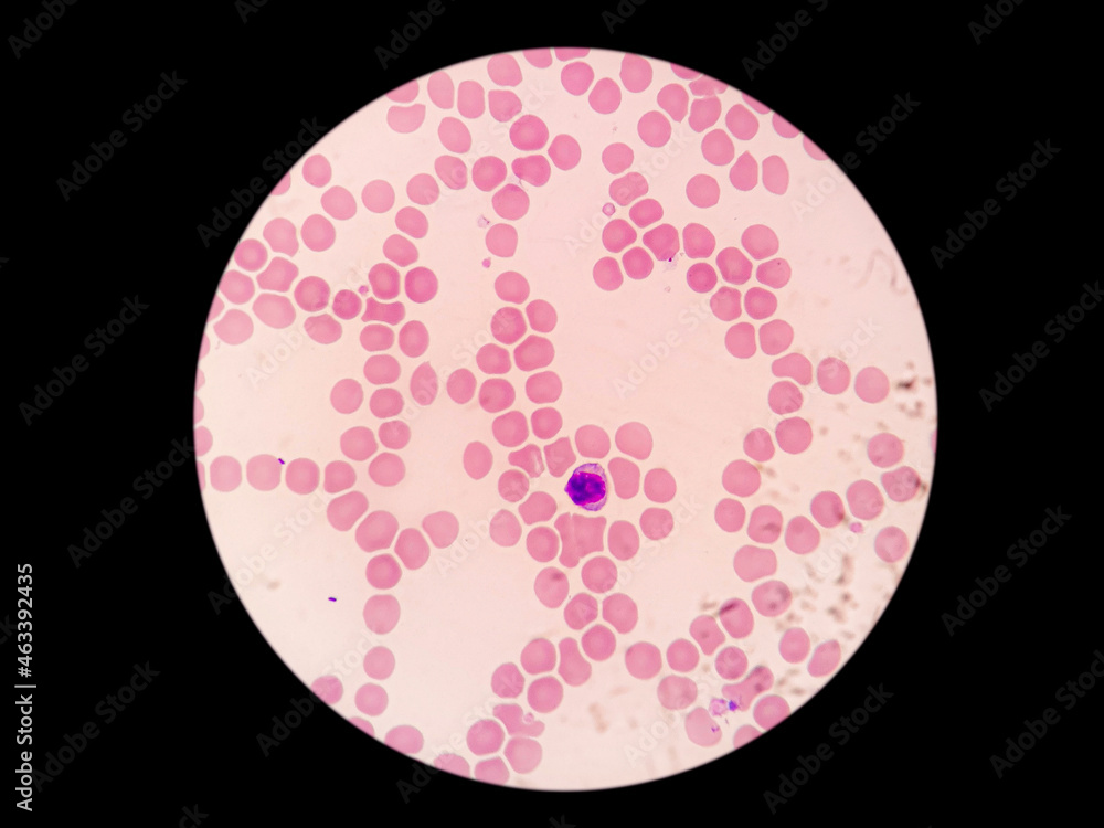 Lonely lymphocyte cell (white blood cell) in peripheral blood smear ...