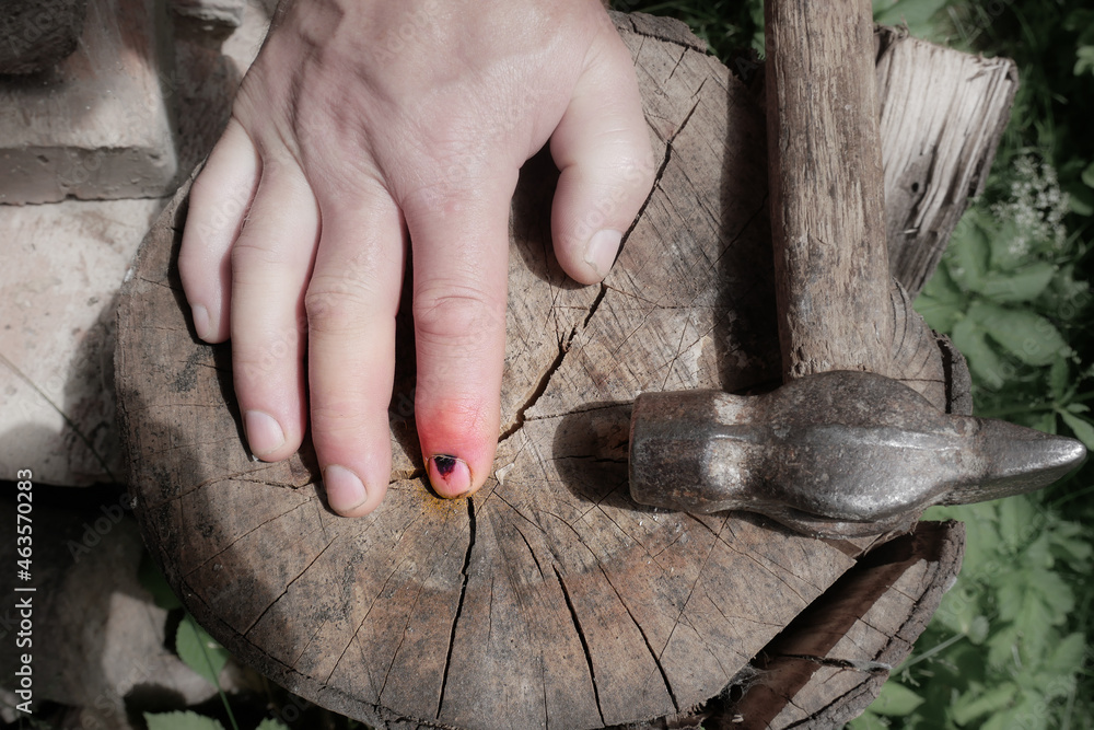 Hammer and human finger with dark bruised nail. Finger injury. Black ...