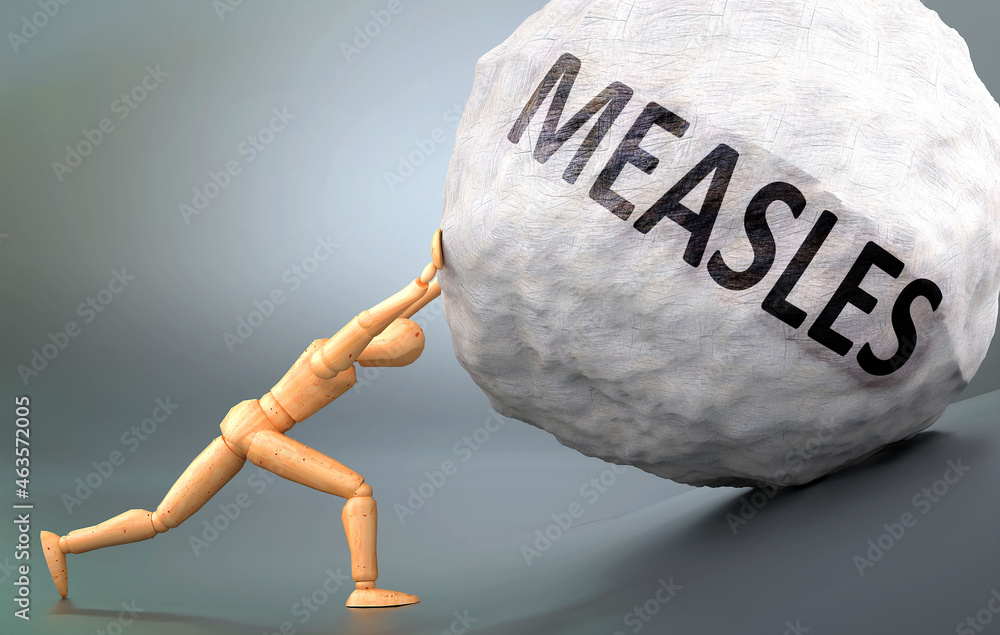 Measles - depiction, impression and presentation of this condition ...