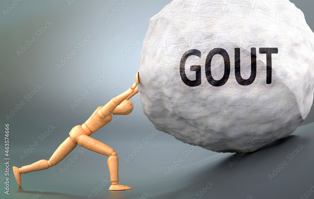 Gout - depiction, impression and presentation of this condition shown a ...