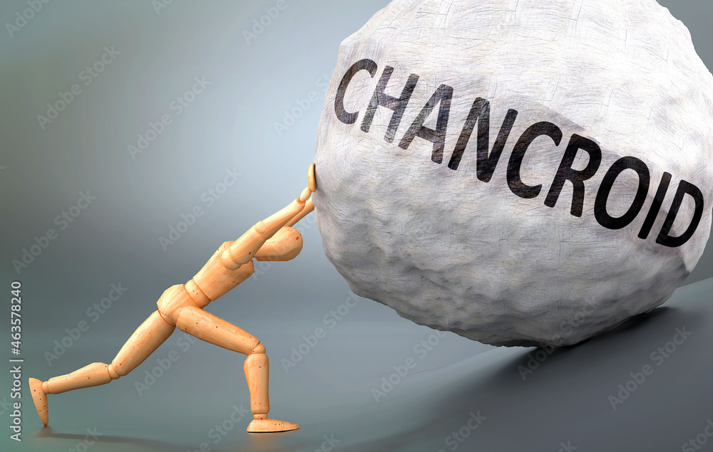 Chancroid - depiction, impression and presentation of this condition ...