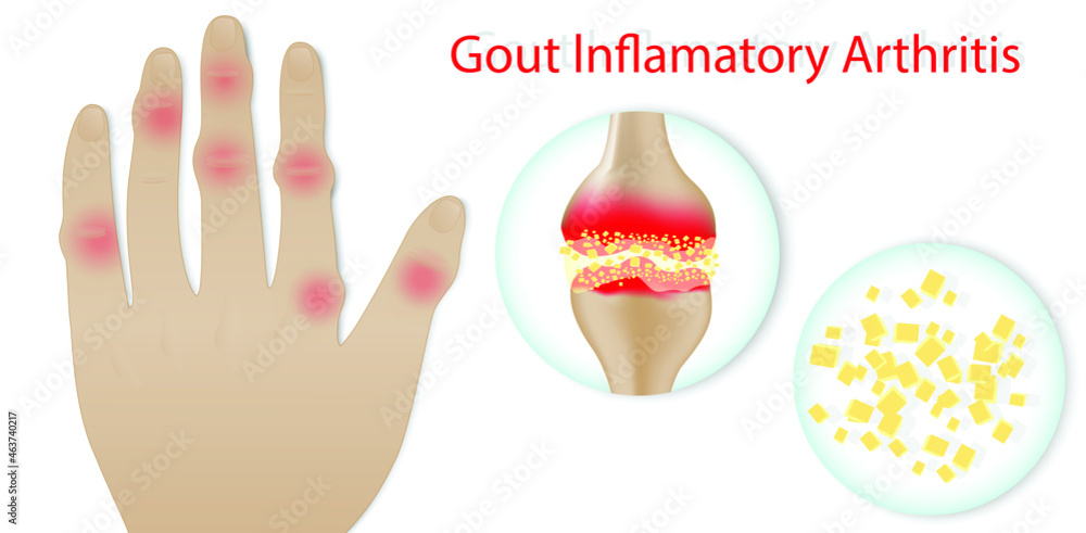 Illustration of Gout disease in Human, Auto immune disorder in humans ...