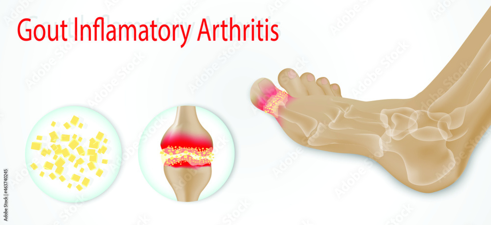 Illustration of Gout disease in Human, Auto immune disorder in humans ...