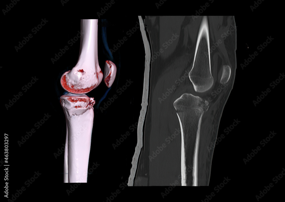Compare of CT knee joint 3D rendering image lateral view and CT knee 2D ...