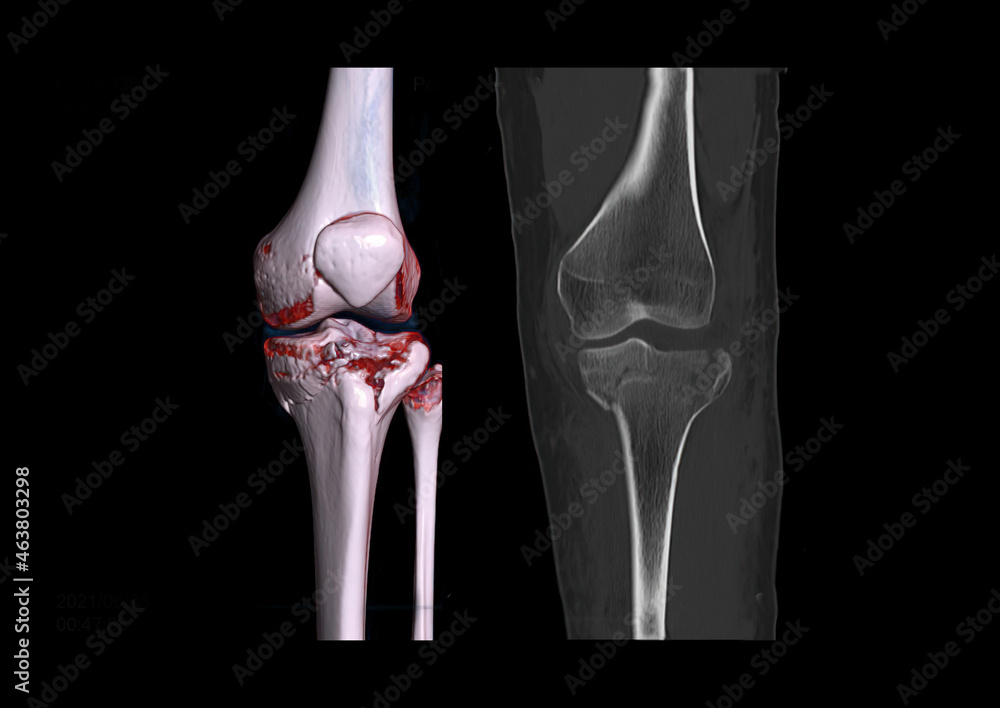 Compare of CT knee joint 3D rendering image and CT knee 2D Coronal view ...
