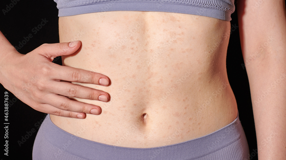 Rash On Stomach