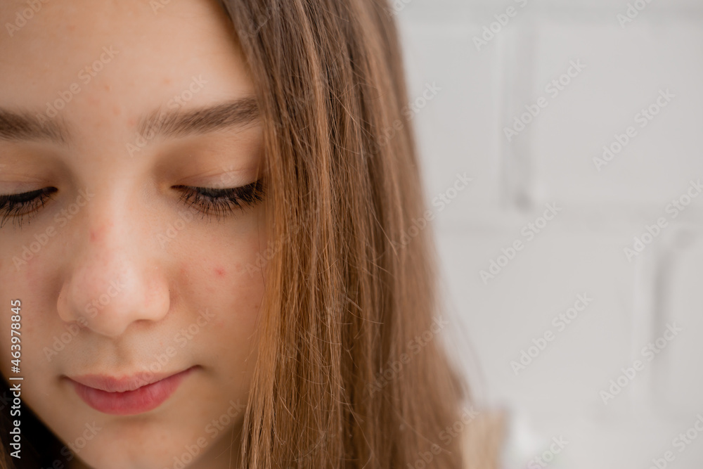 Face of a teenage girl in close up. Teen with problematic skin. Girl ...