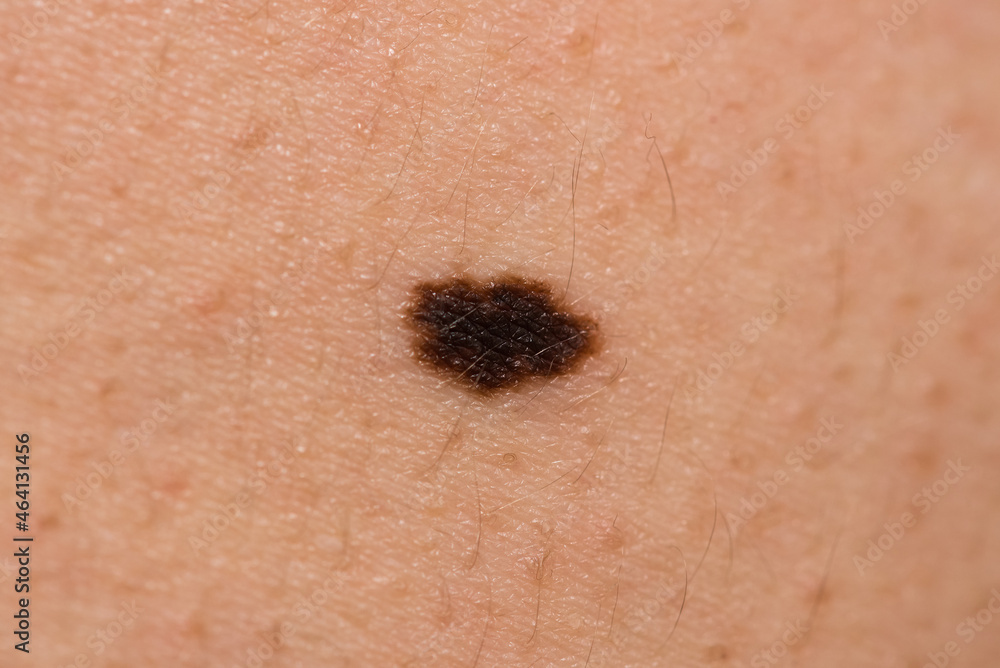Suspicious mole on skin. Brown birthmark (nevus) on caucasian woman ...