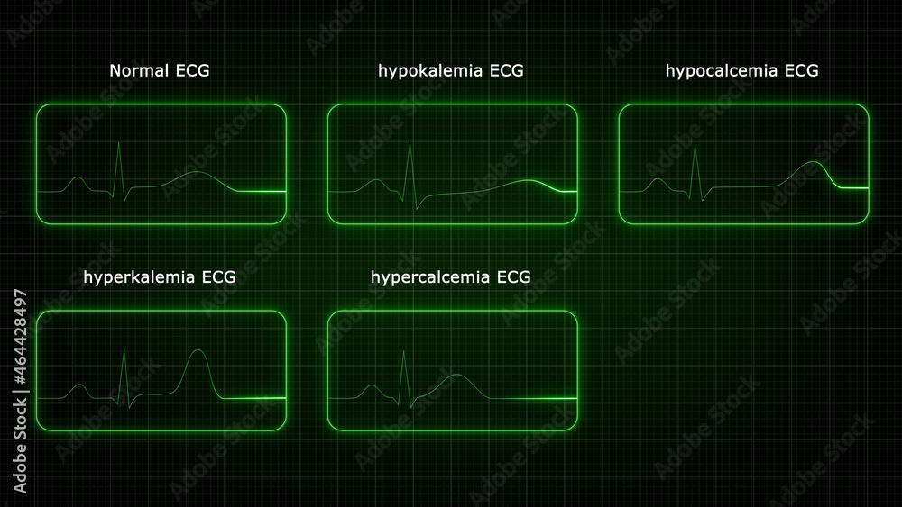 An electrocardiogram (ECG) is a simple test that can be used to check ...