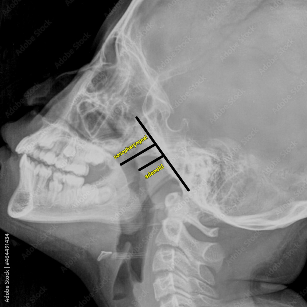Adenoid Hypertrophy X Ray