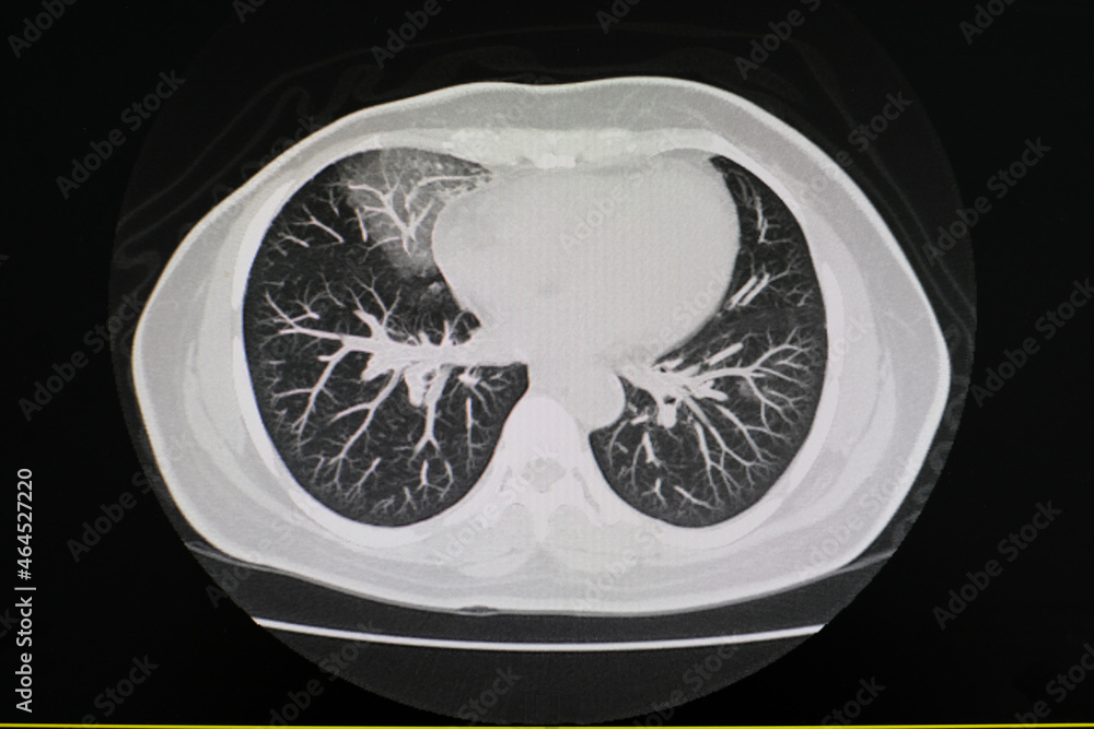 CT scan (computed tomography) of chest organs. Stock Photo | Adobe Stock
