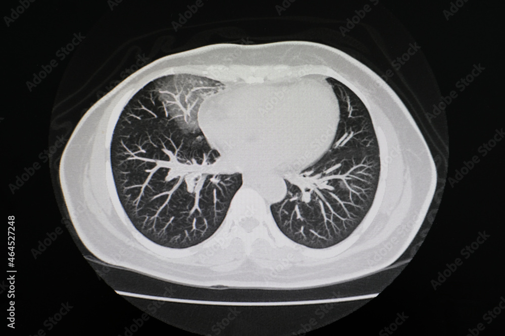 CT scan (computed tomography) of chest organs. Stock Photo | Adobe Stock